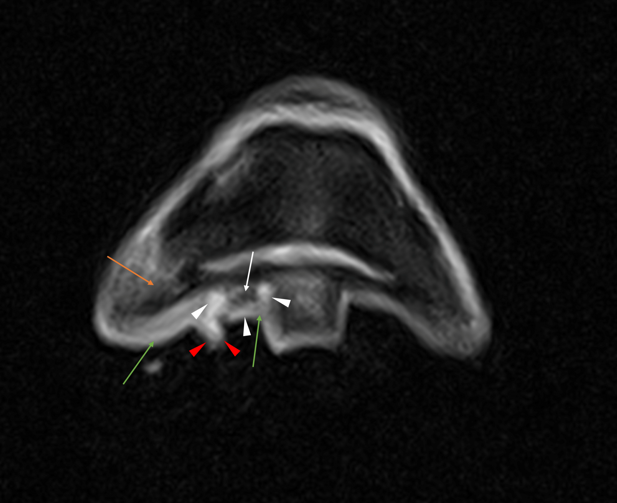 Persistently draining solar abscess from right hind foot - Hallmarq ...