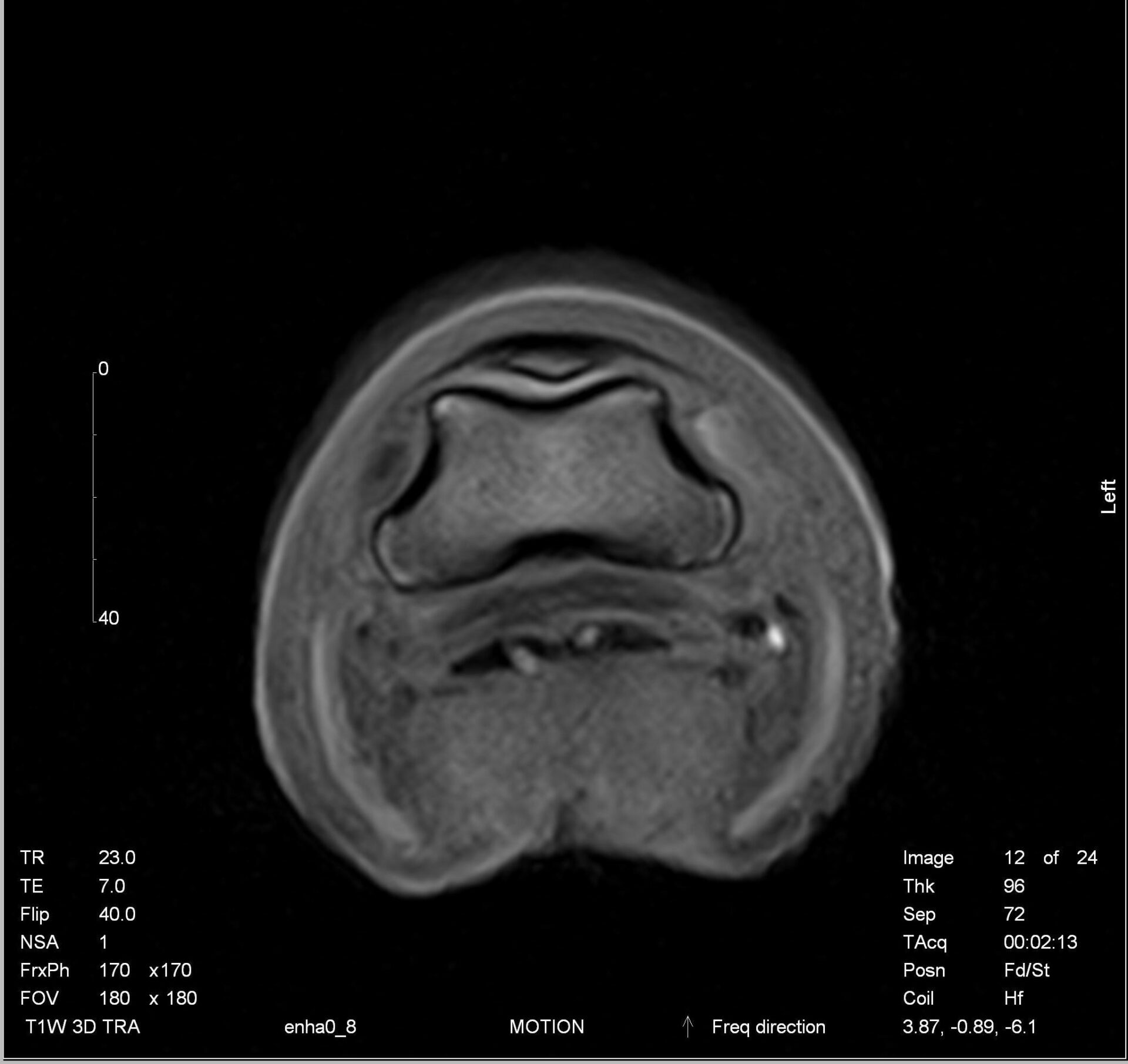 The Use of MRI in Evaluating Musculoskeletal Structures - Hallmarq ...
