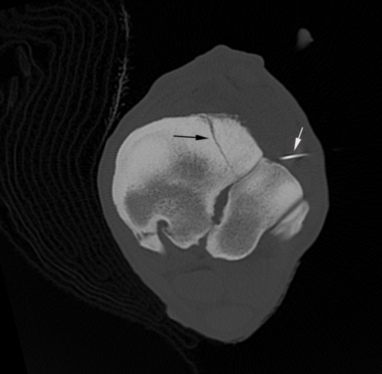 Multimodal Imaging For Central Tarsal Bone Fracture - Hallmarq ...