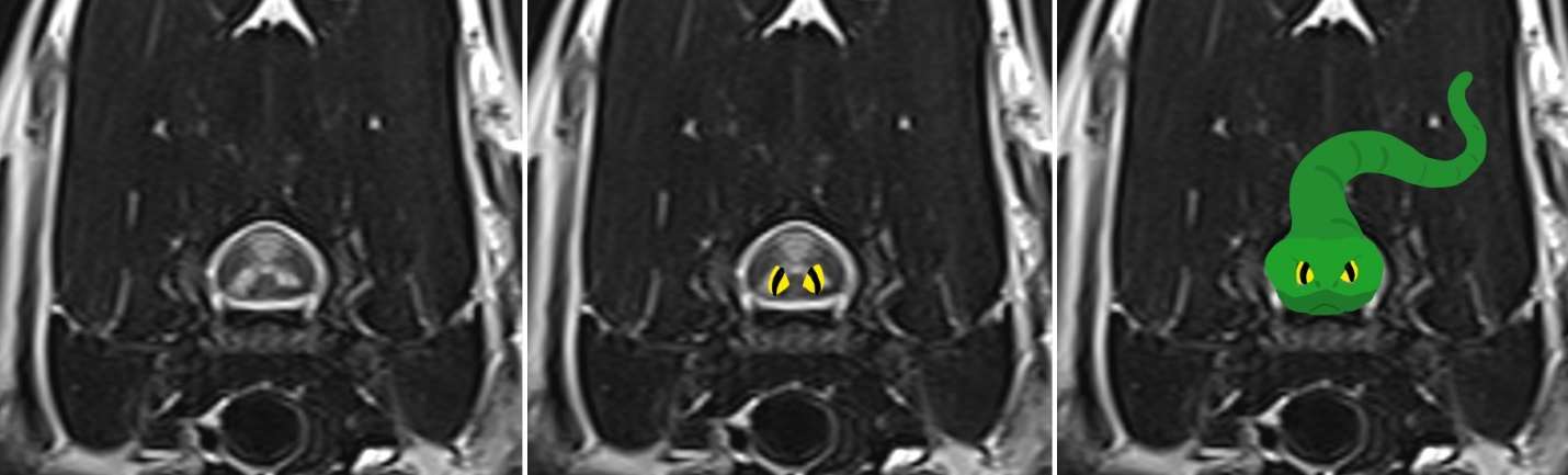 Pareidolia in MRI: finding hidden patterns in medical imaging ...