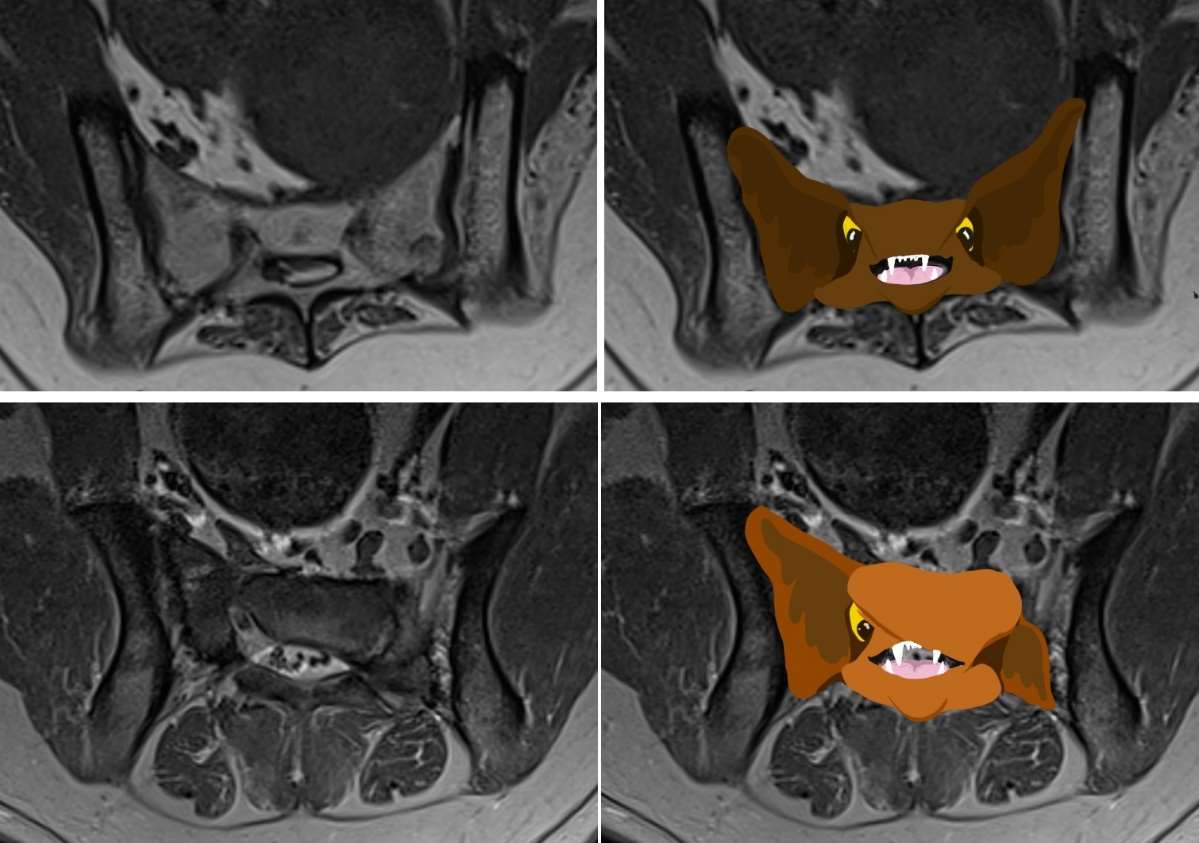 Pareidolia in MRI: finding hidden patterns in medical imaging ...