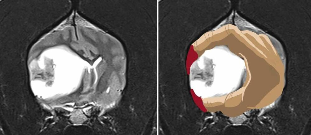 Pareidolia in MRI: finding hidden patterns in medical imaging ...