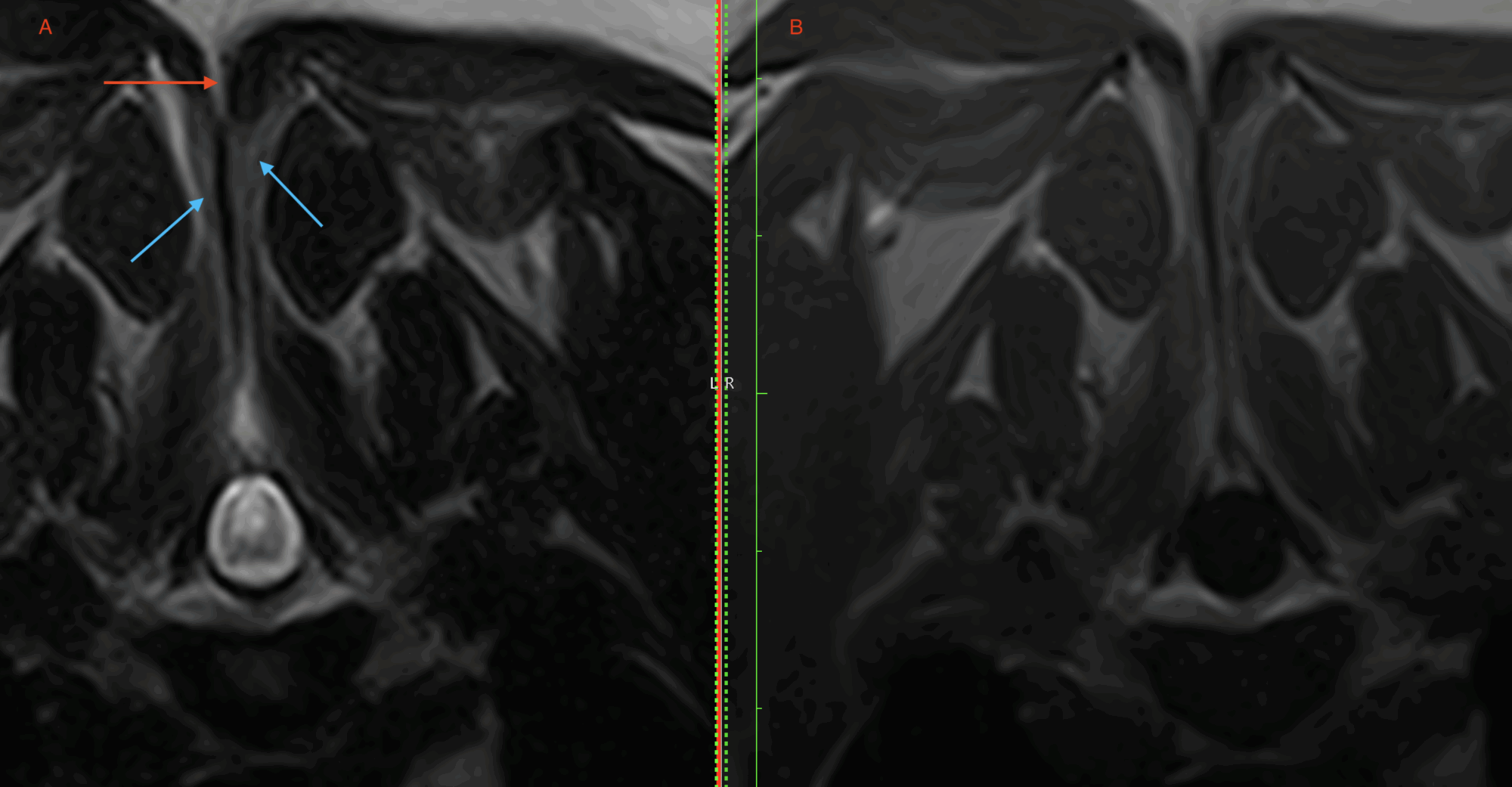 A dermoid cyst, meningomyelocele, and spina bifida in an adult dog ...
